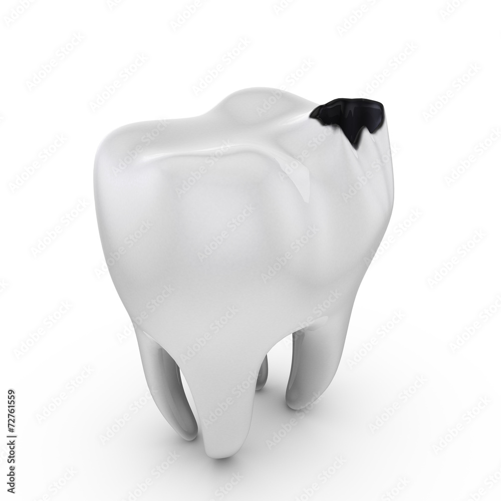 tooth decay Stock Illustration | Adobe Stock
