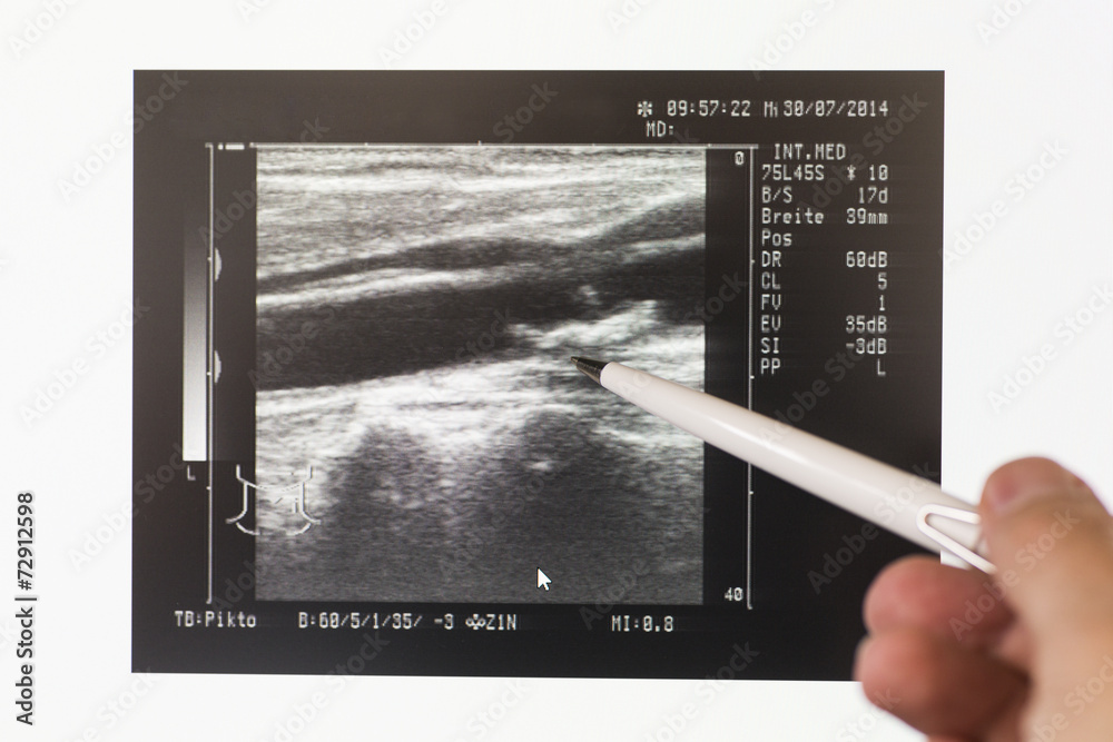 Ultraschallbild einer Halsschlagader( Arteria Carotis communis) Stock ...