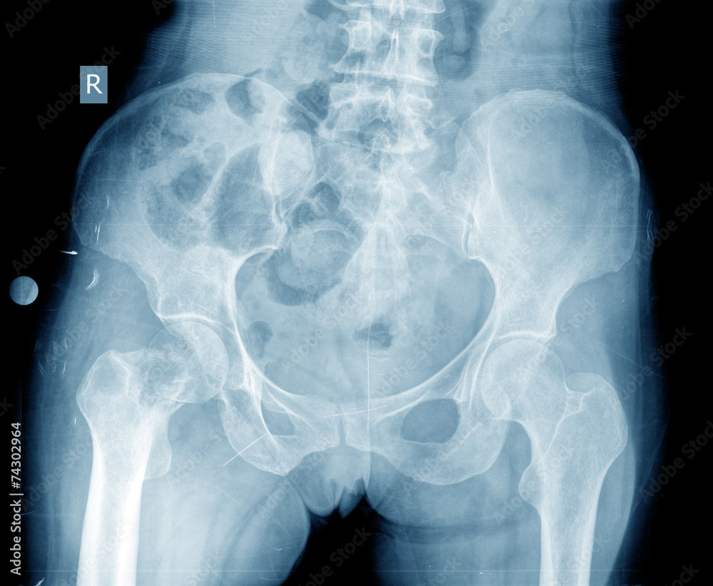 x-ray of hip Stock Photo | Adobe Stock