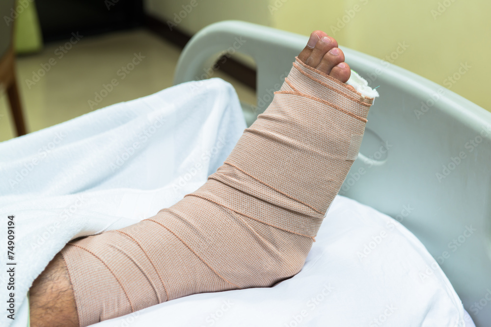 Patient with broken leg in cast and bandage Stock Photo | Adobe Stock
