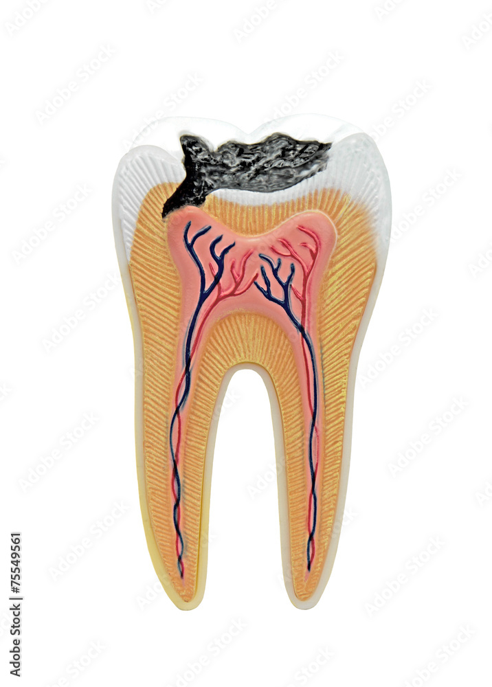 Cross section of a tooth model with caries. Stock Photo | Adobe Stock