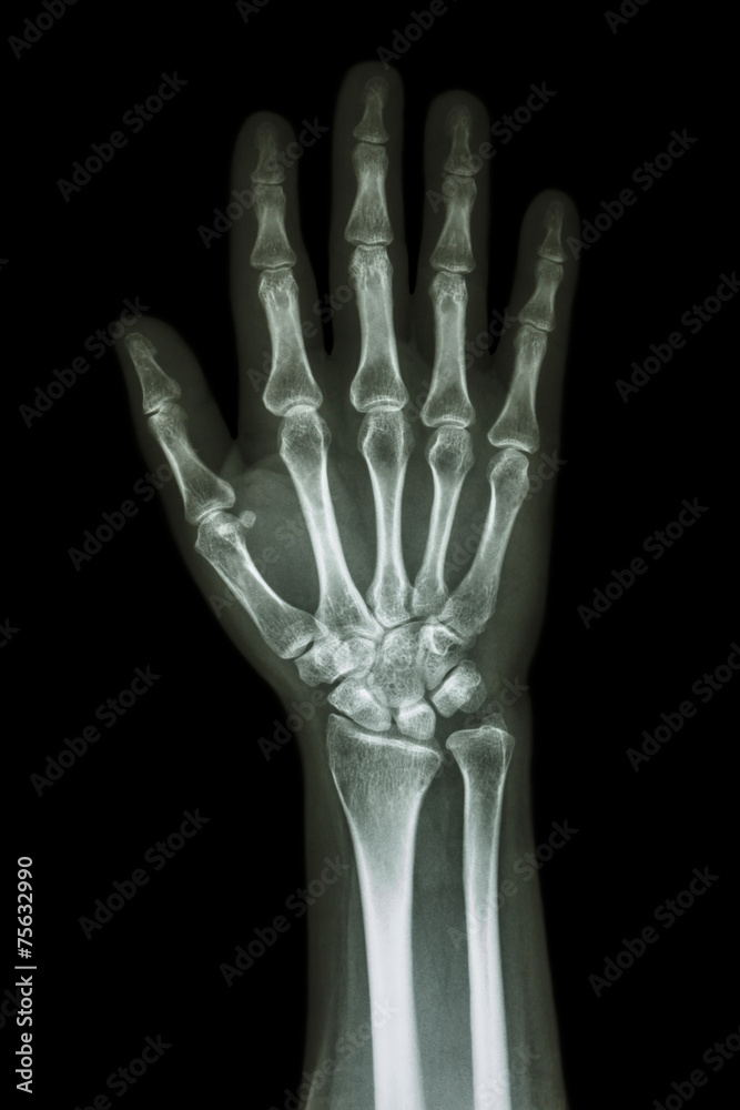 X-ray hand & forearm Stock Photo | Adobe Stock