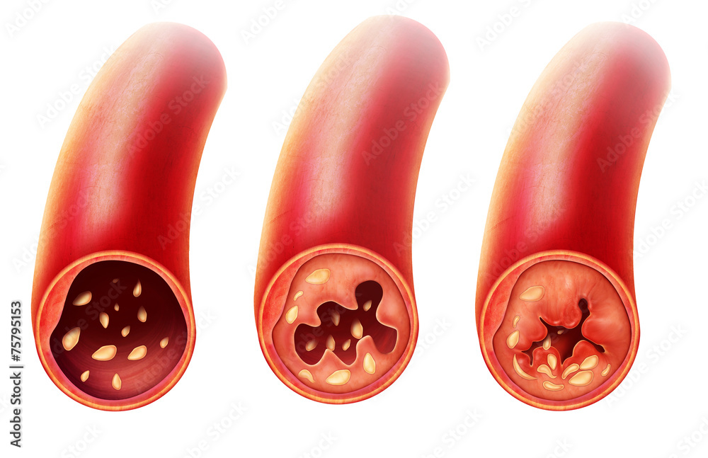 Anatomy of Atherosclerosis in artery Stock Illustration | Adobe Stock