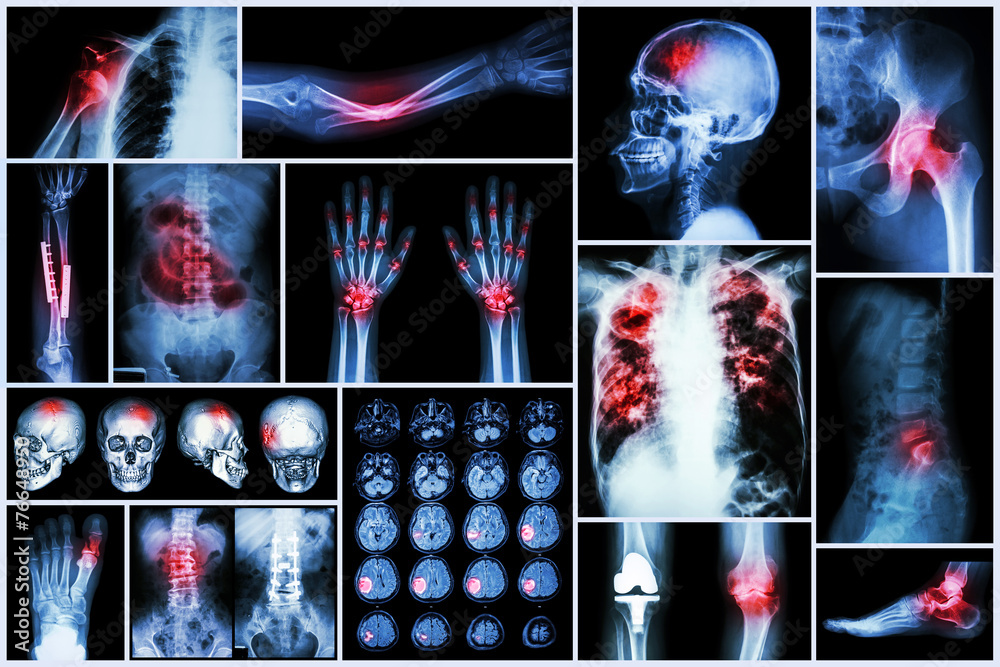 X-ray multiple disease (Stroke,tuberculosis ,Bone fracture , etc Stock ...
