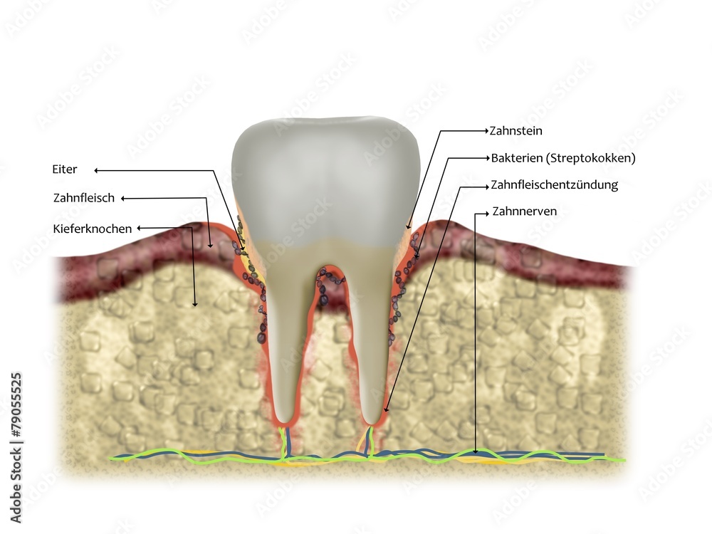 bakterielle entzündung am zahnfleisch Stock Illustration | Adobe Stock