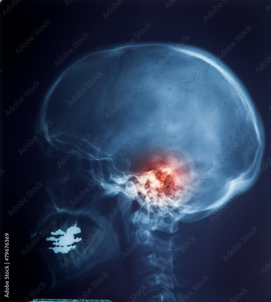Foto de X ray MRI - Image of Spinal Column Neck pain and Skull Head ...