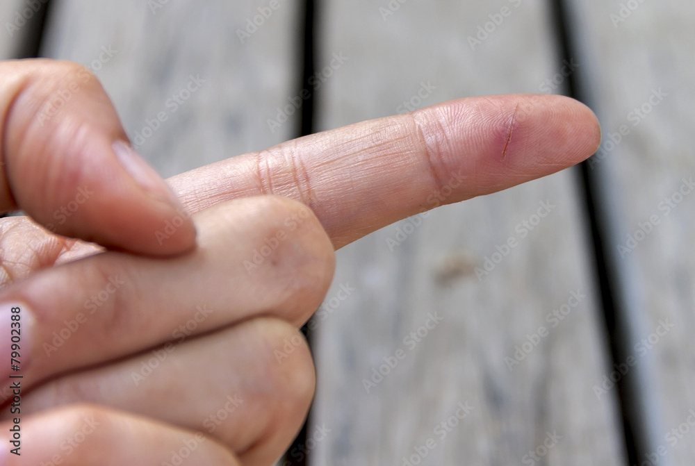 Cut on finger Stock Photo | Adobe Stock