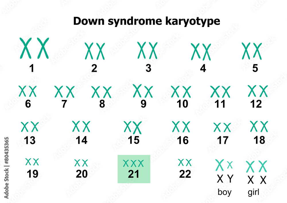 Down syndrome karyotype Stock Vector | Adobe Stock