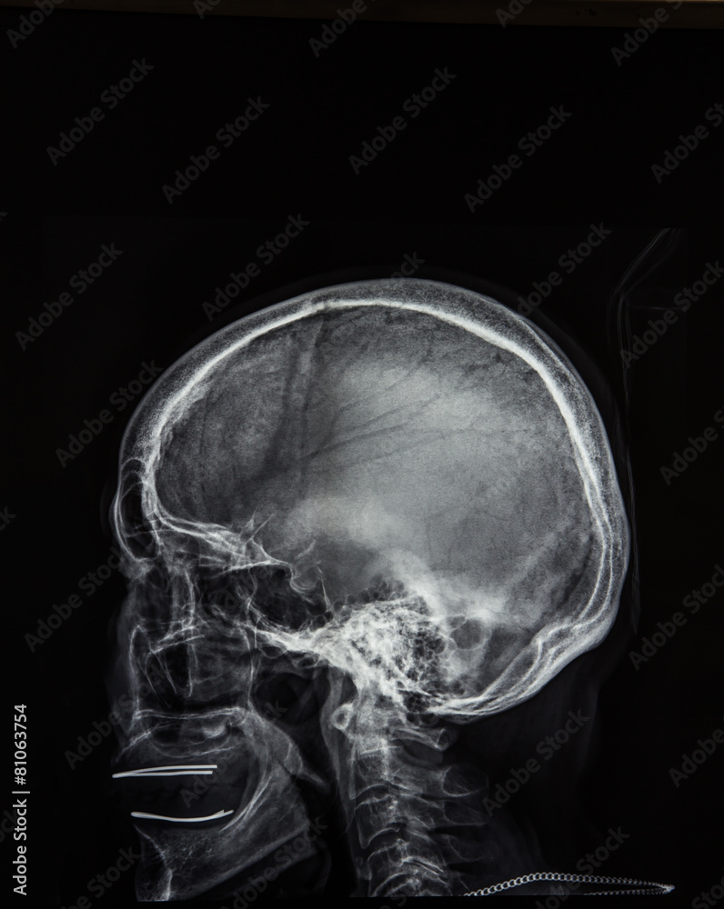 X-ray of head / Many others X-ray images in my portfolio Stock Photo ...