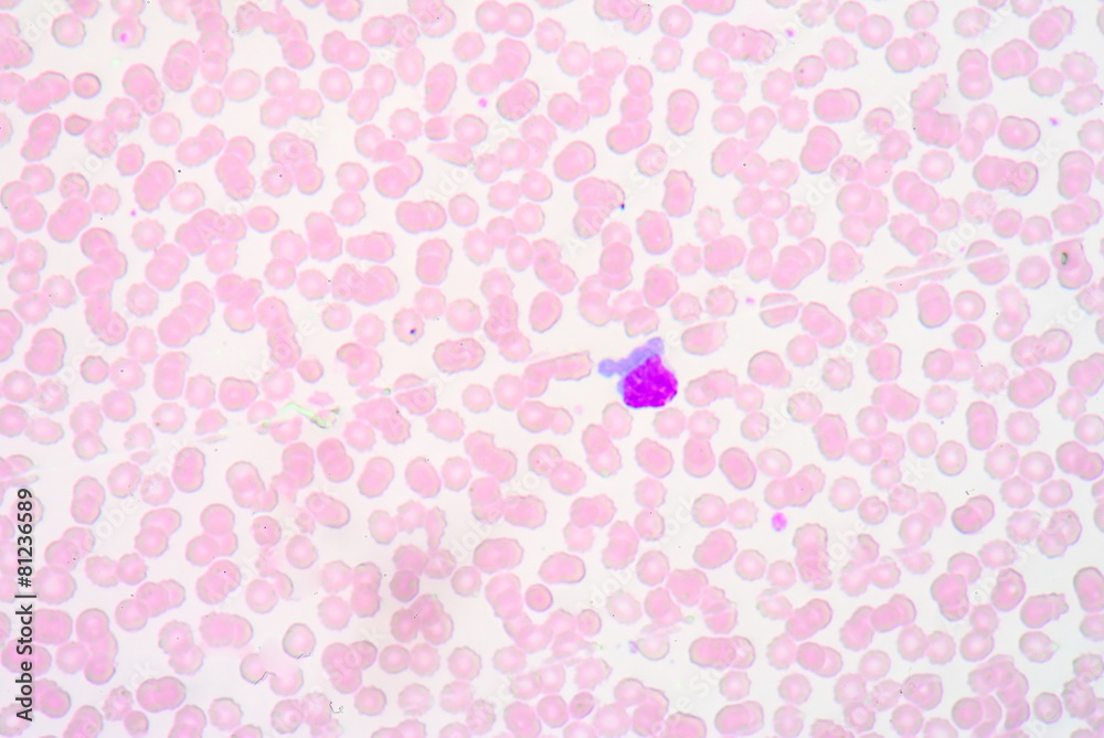 A blood smear is often used as a follow-up test to abnormal resu Stock ...