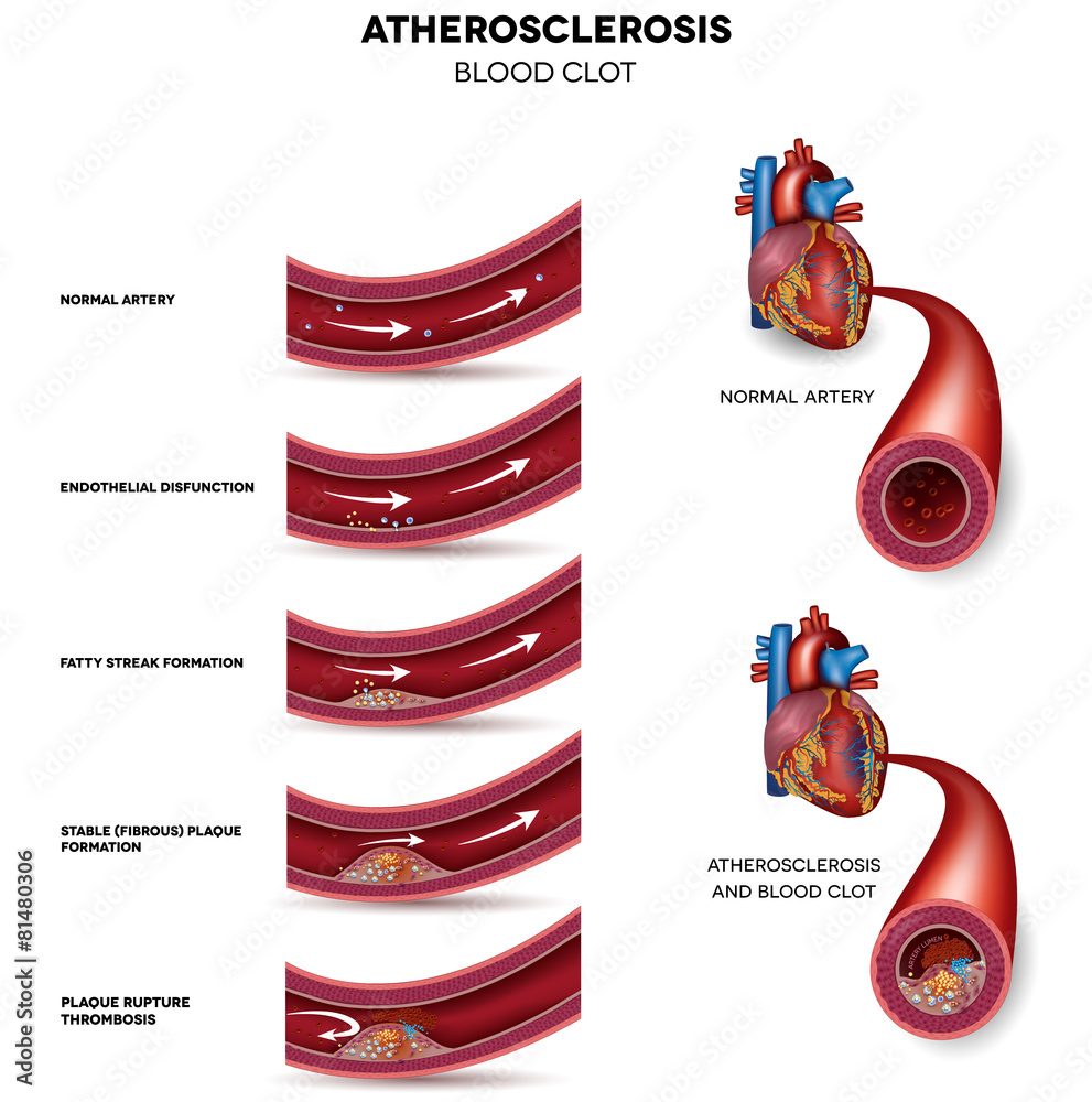 Atherosclerosis stages, normal heart and damaged heart muscle Stock ...