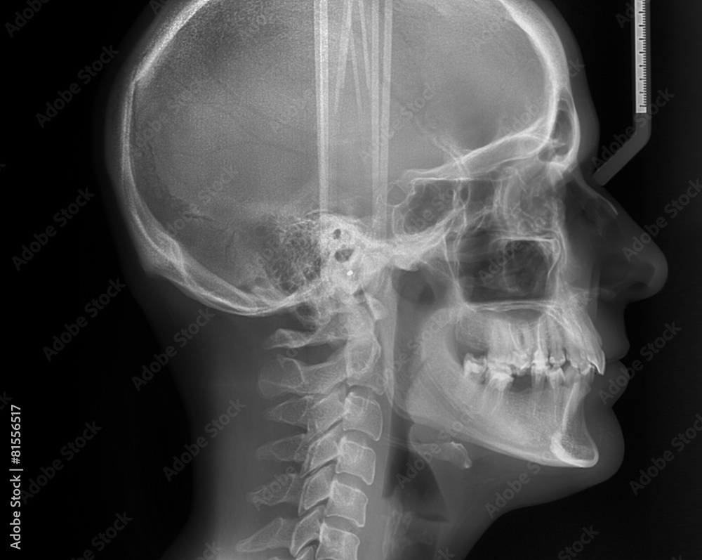 Lateral Cephalometric Radiograph Stock Illustration Adobe Stock