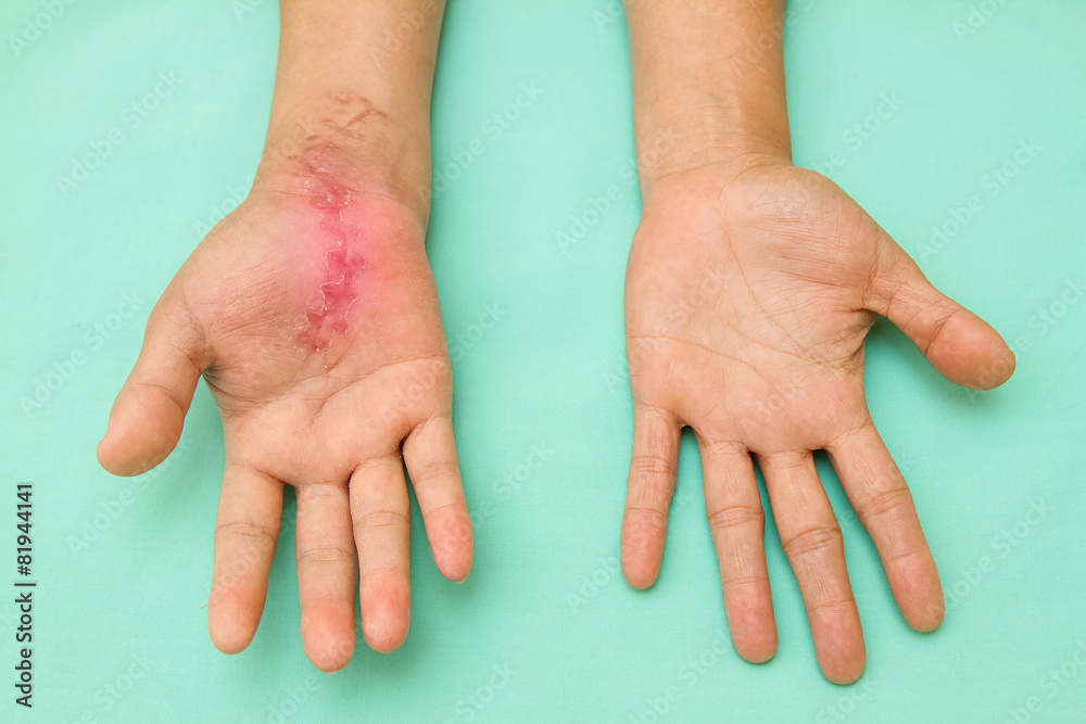 Scar wound on swollen and inflamed hand after accident Stock Photo ...