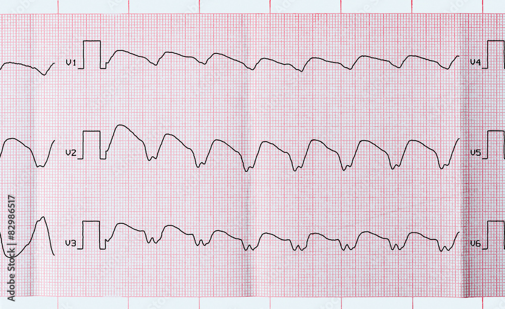 Paroxysmal Atrial Tachycardia