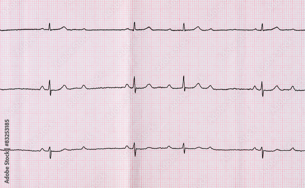 ECG with atrioventricular block II degree type Mobitts I Stock-Foto ...