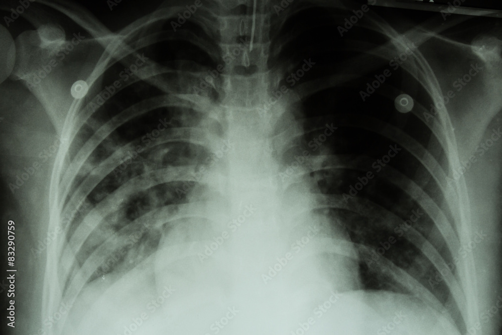 Pulmonary Tuberculosis ( TB ) : Chest x-ray Stock Photo | Adobe Stock