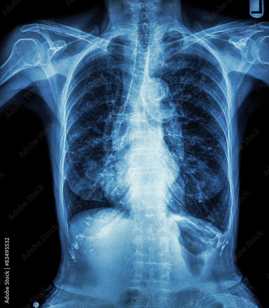 Chest X-ray of old patient ( calcification at rib , trachea ) Stock ...