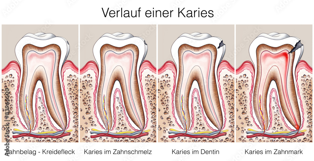 Karies-Verlauf in 4 Stufen Stock Illustration | Adobe Stock
