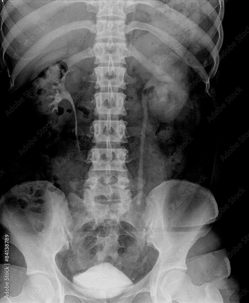 Hydronephrosis X Ray