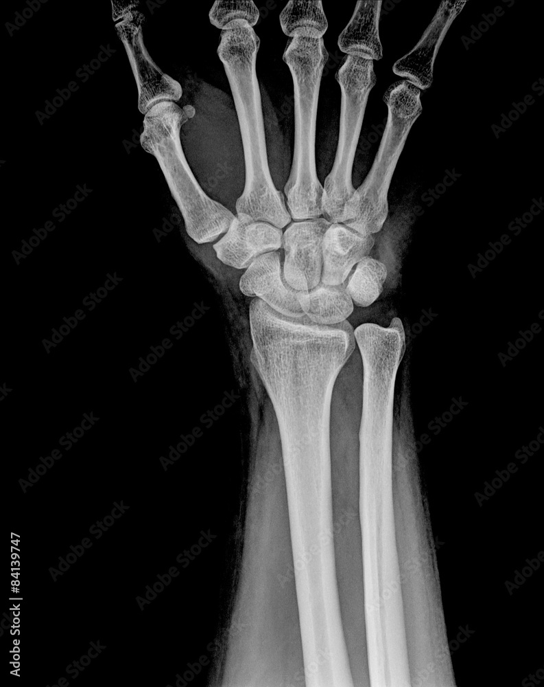 x-ray image show fracture of the radius bone Stock Photo | Adobe Stock