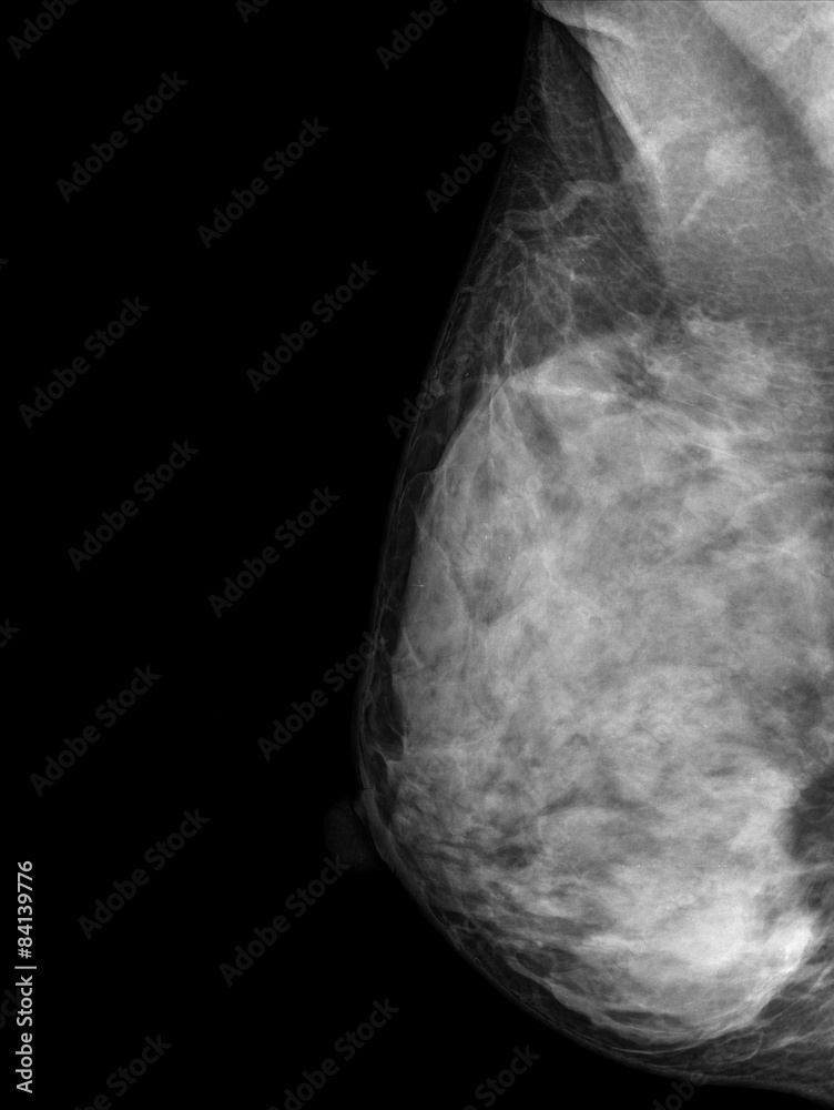 Mammogram radio imaging for breast cancer diagnosis Stock Photo | Adobe ...