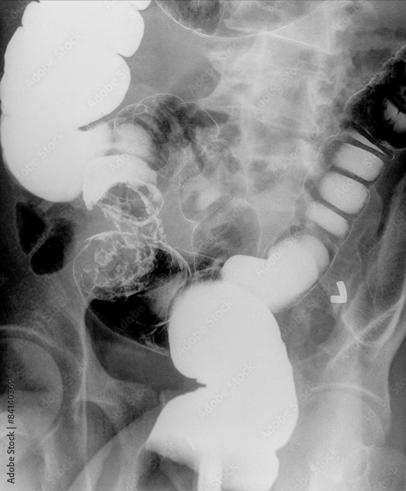 x ray Colon with barium,AP view , Pre evacuation Stock Photo | Adobe Stock