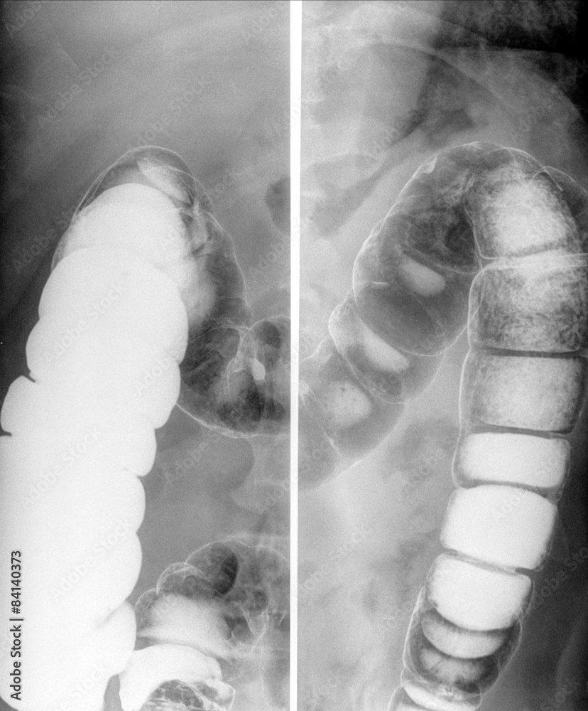 x ray Colon with barium,AP view , Pre evacuation Stock Photo | Adobe Stock