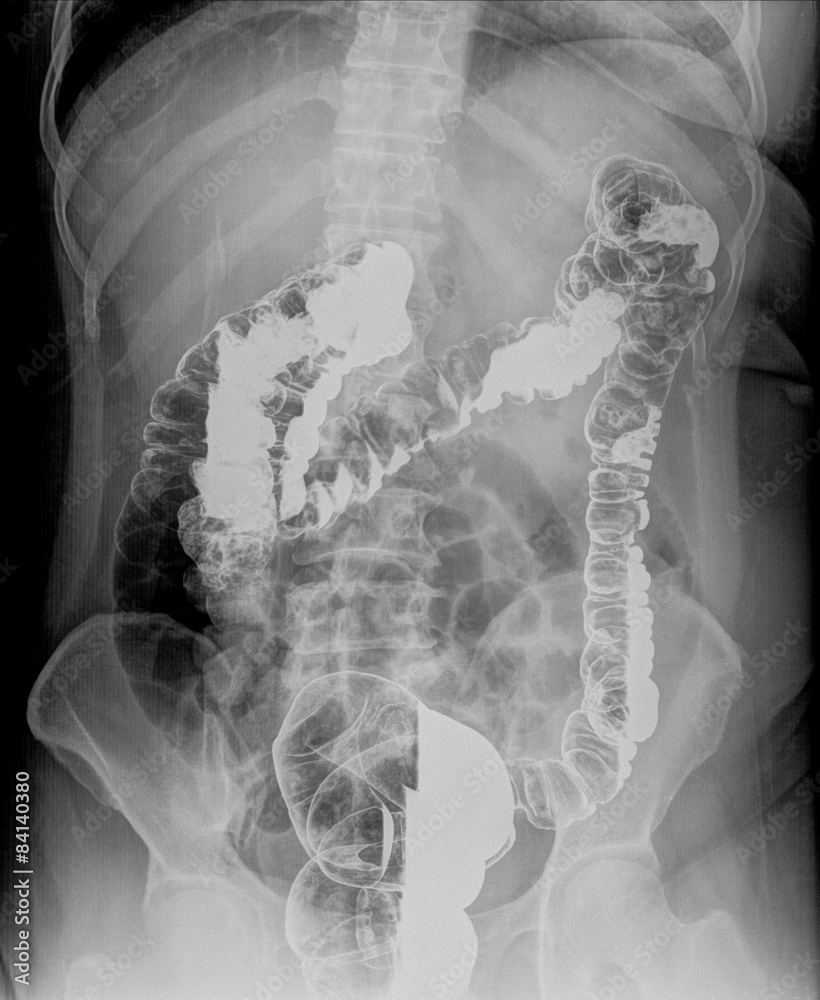 x ray Colon with barium,AP view Stock Photo | Adobe Stock