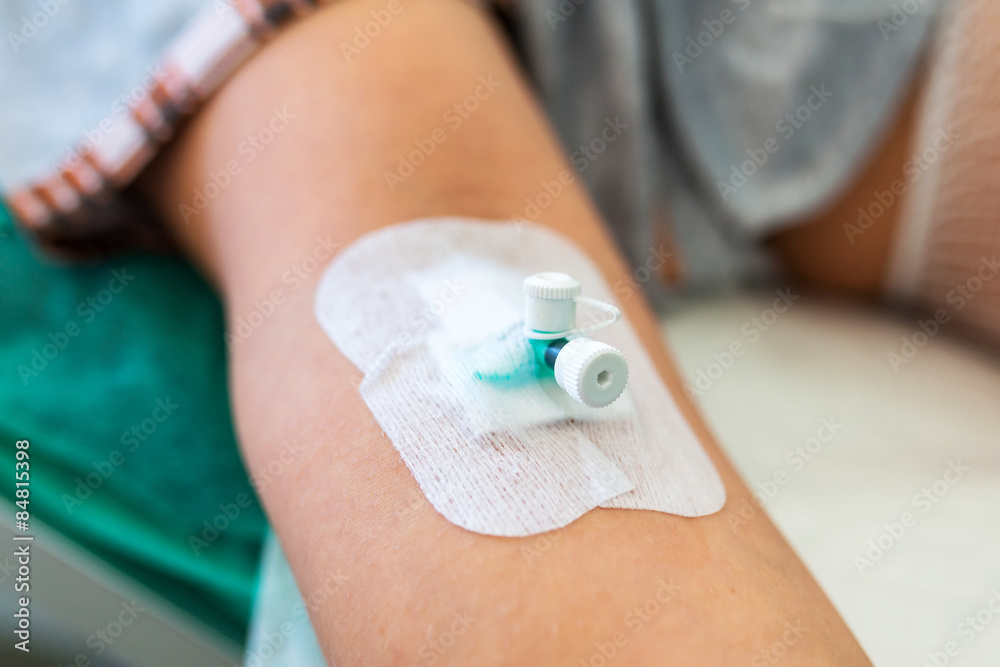 Peripheral venous catheter in the vein of human hand Stock Photo ...