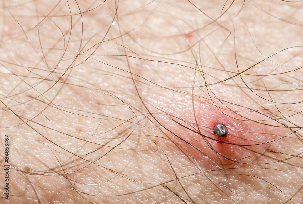 Tick attached on man skin foto de Stock | Adobe Stock