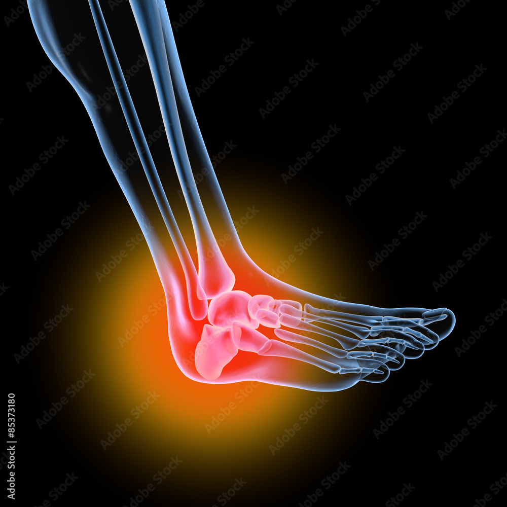 Arthrose Fußgelenk, Gelenkschmerzen, Illustration 3D Stock Illustration ...