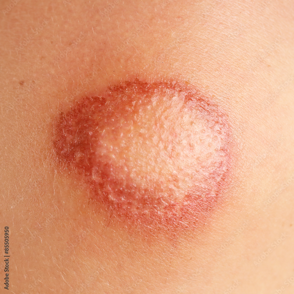 Close up view of nasty wounds Stock Photo | Adobe Stock