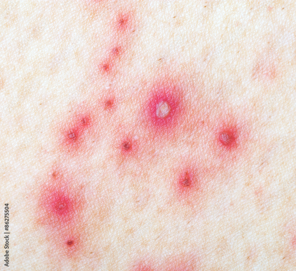 Herpes Zoster (Shingles) Stock Photo | Adobe Stock