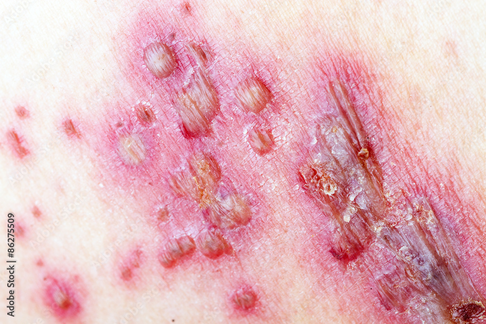 Herpes Zoster (Shingles) Stock Photo | Adobe Stock