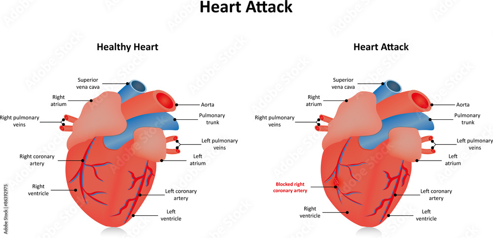 Heart Attack Stock Vector | Adobe Stock