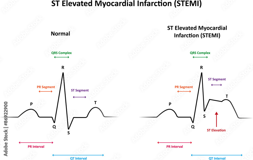 ST Elevated Myocardial Infarction Stock Illustration | Adobe Stock