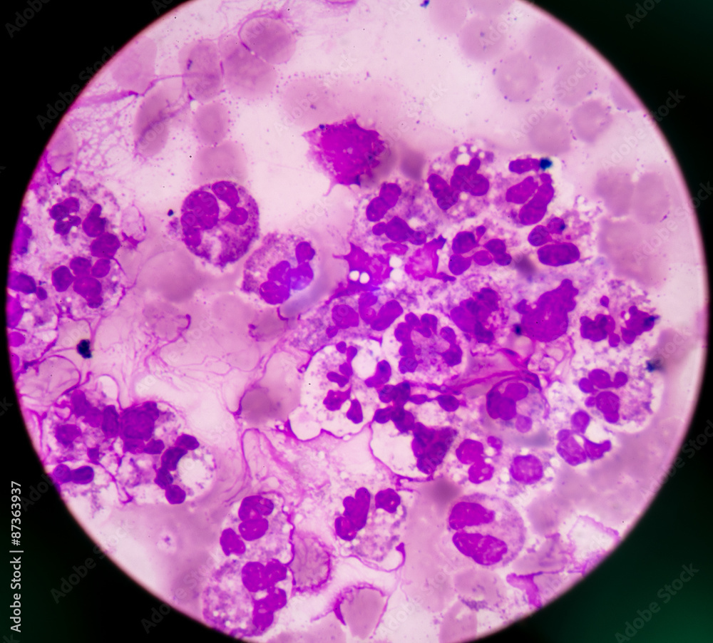 Abnormal neutrophil in pleural fluid smear. Stock Photo | Adobe Stock