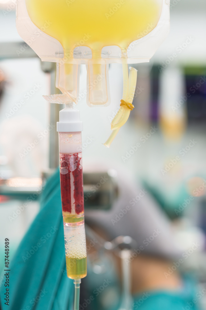giving single doner platelet during open heart surgery Stock Photo ...