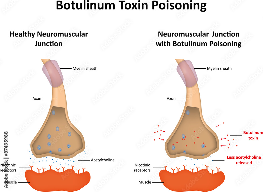 Botulinum Toxin Illustration Stock | Adobe Stock
