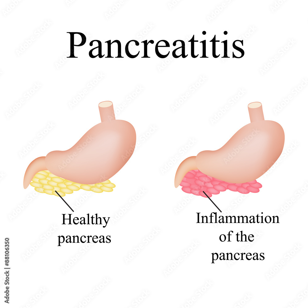 Inflammation of the pancreas. Pancreatitis. Vector illustration Stock ...