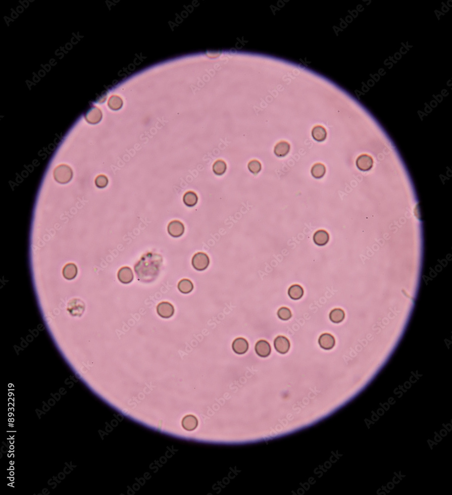Fresh Red Blood Cells In Urine Specimen Under Microscope 400x Stock fresh-red-blood-cells-in-urine-specimen-under-microscope-400x-stock