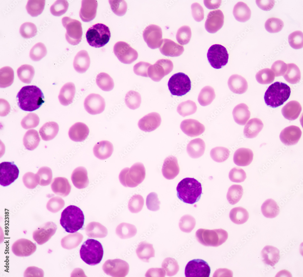 Acute lymphoblastic leukemia(ALL) Stock Photo | Adobe Stock