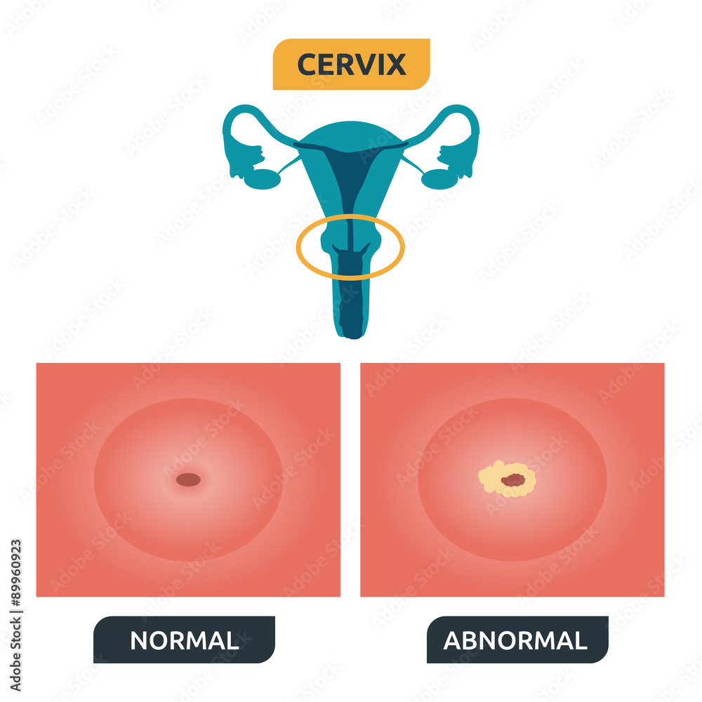 Cervix Stock Vector | Adobe Stock