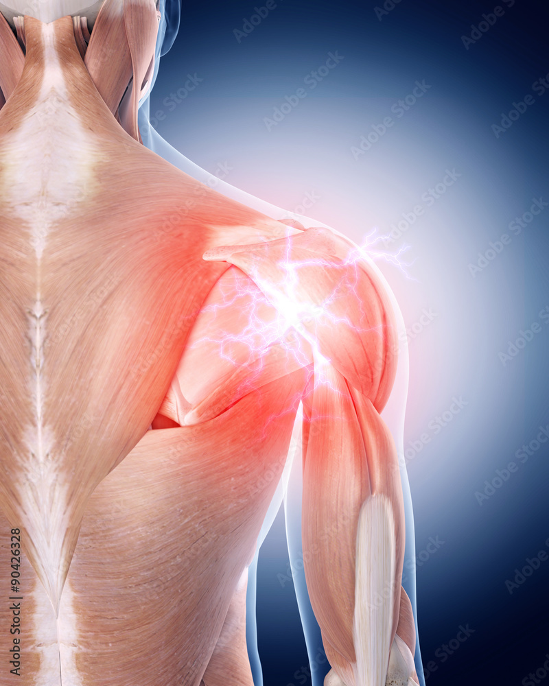 medical 3d illustration of a painful shoulder Stock Illustration ...