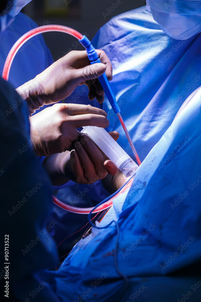 Hip replacement cement insertion and suction of fluids Stock Photo ...