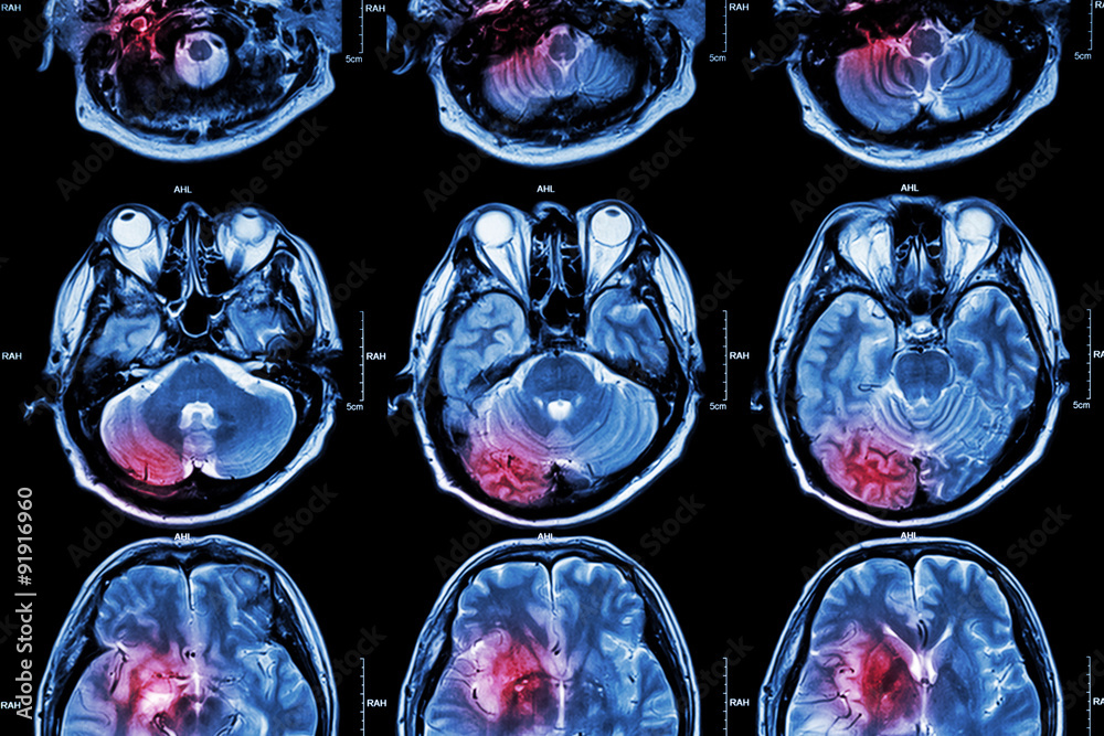 Photo Art Print Film MRI Magnetic resonance imaging of brain stroke brain tumor cerebr stockdevil