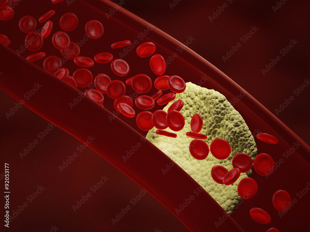 The accumulation of fatty streaks. Arteriosclerotic vascular disease ...