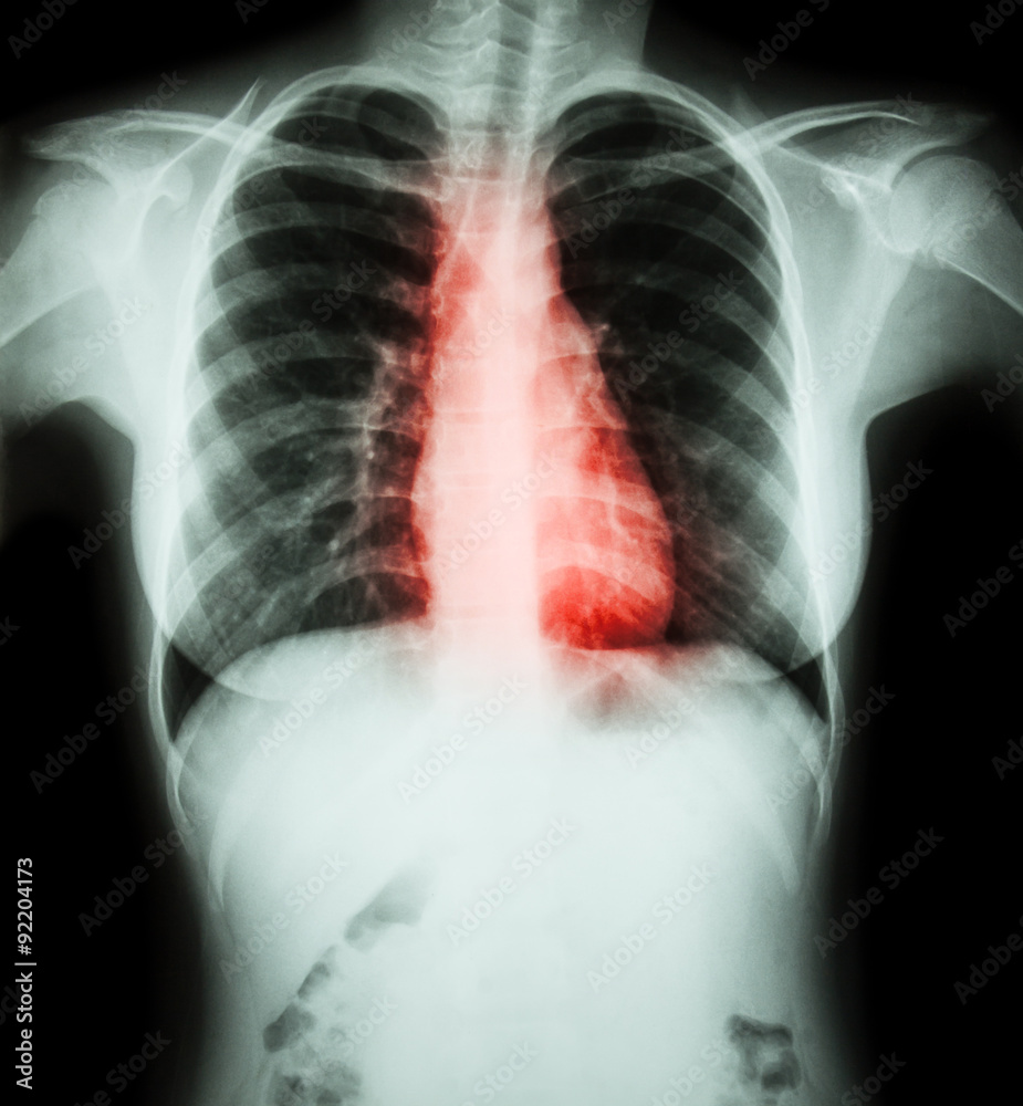 Heart disease ( Film chest x-ray of woman with heart disease ) Stock ...