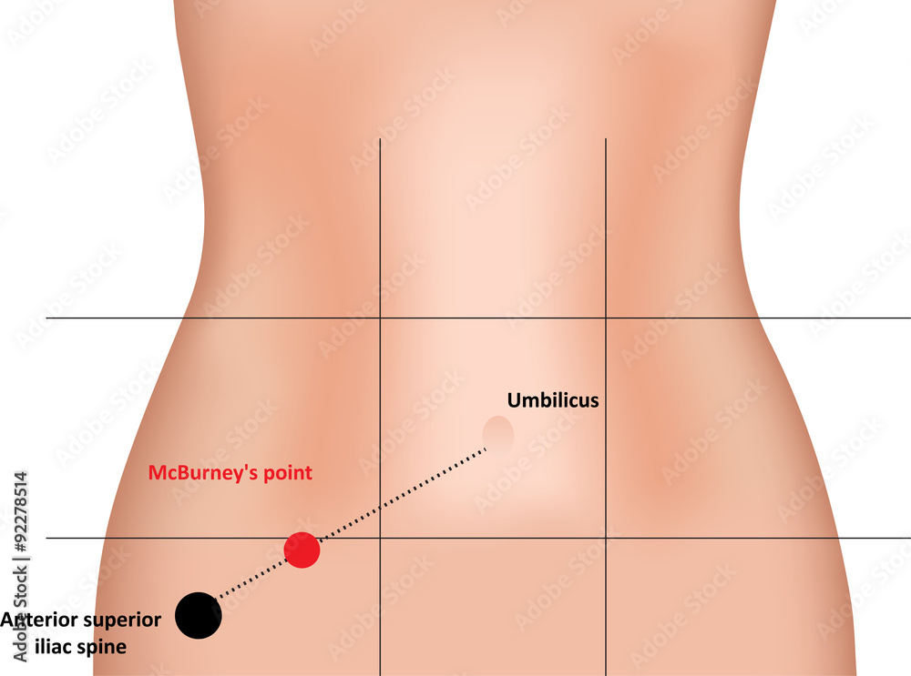 McBurney's Point Stock Illustration | Adobe Stock