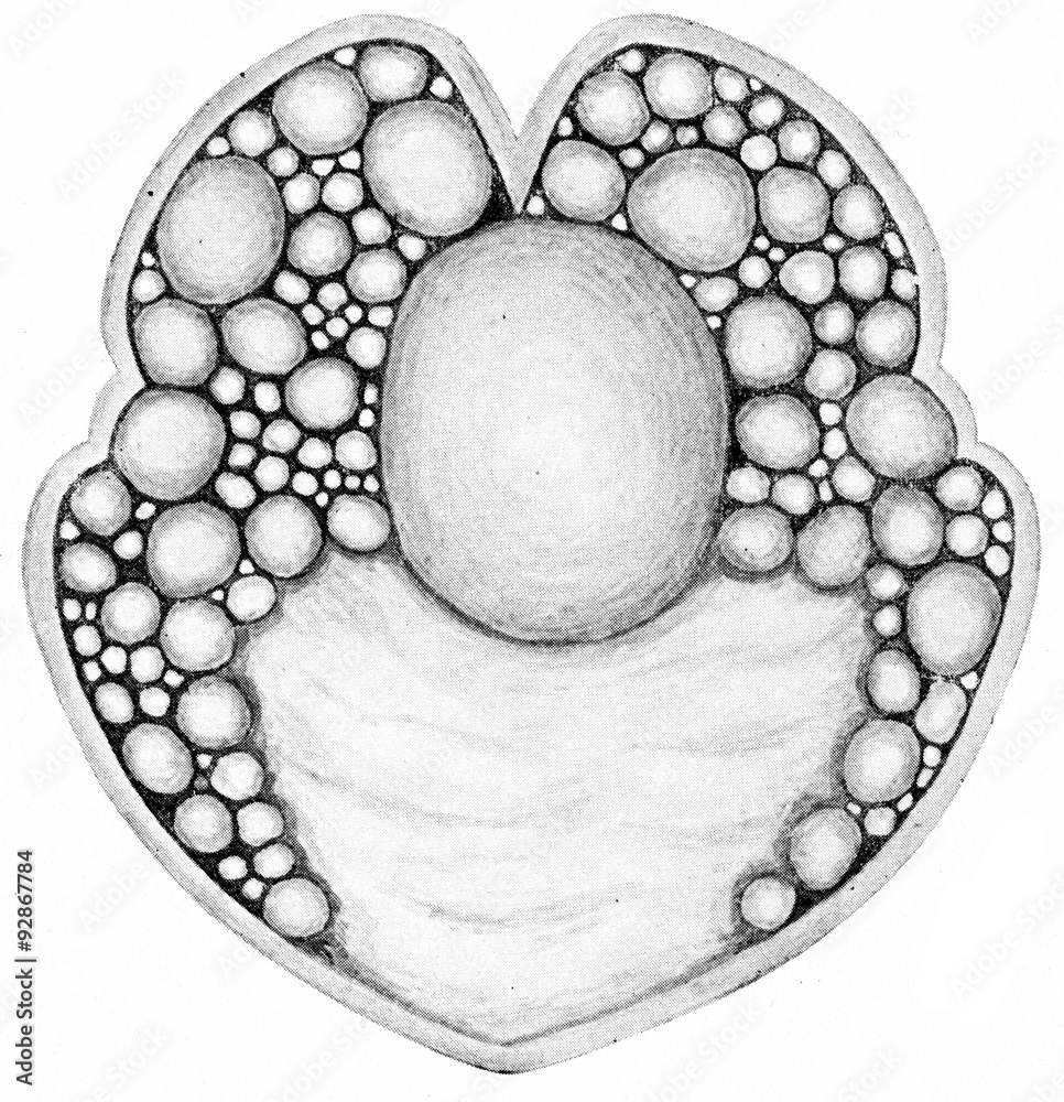 Hydatid cyst, showing daughter cysts, vintage engraving. Stock ...